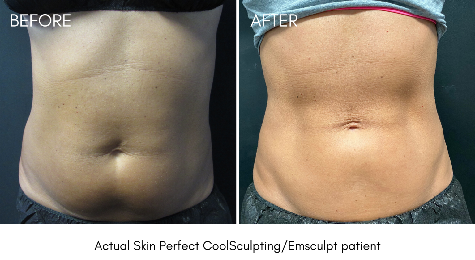 Emsculpt Rancho Cucamonga & San Bernardino | Skin Perfect Medical